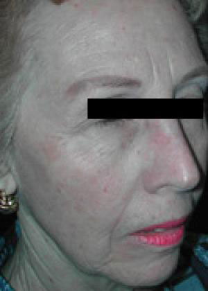 Facial Surgery Archives - Rhinoplasty Institute of Chicago