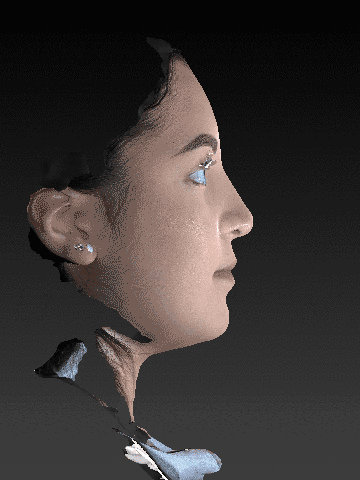 Rhinoplasty Case 1 - Rhinoplasty Institute of Chicago